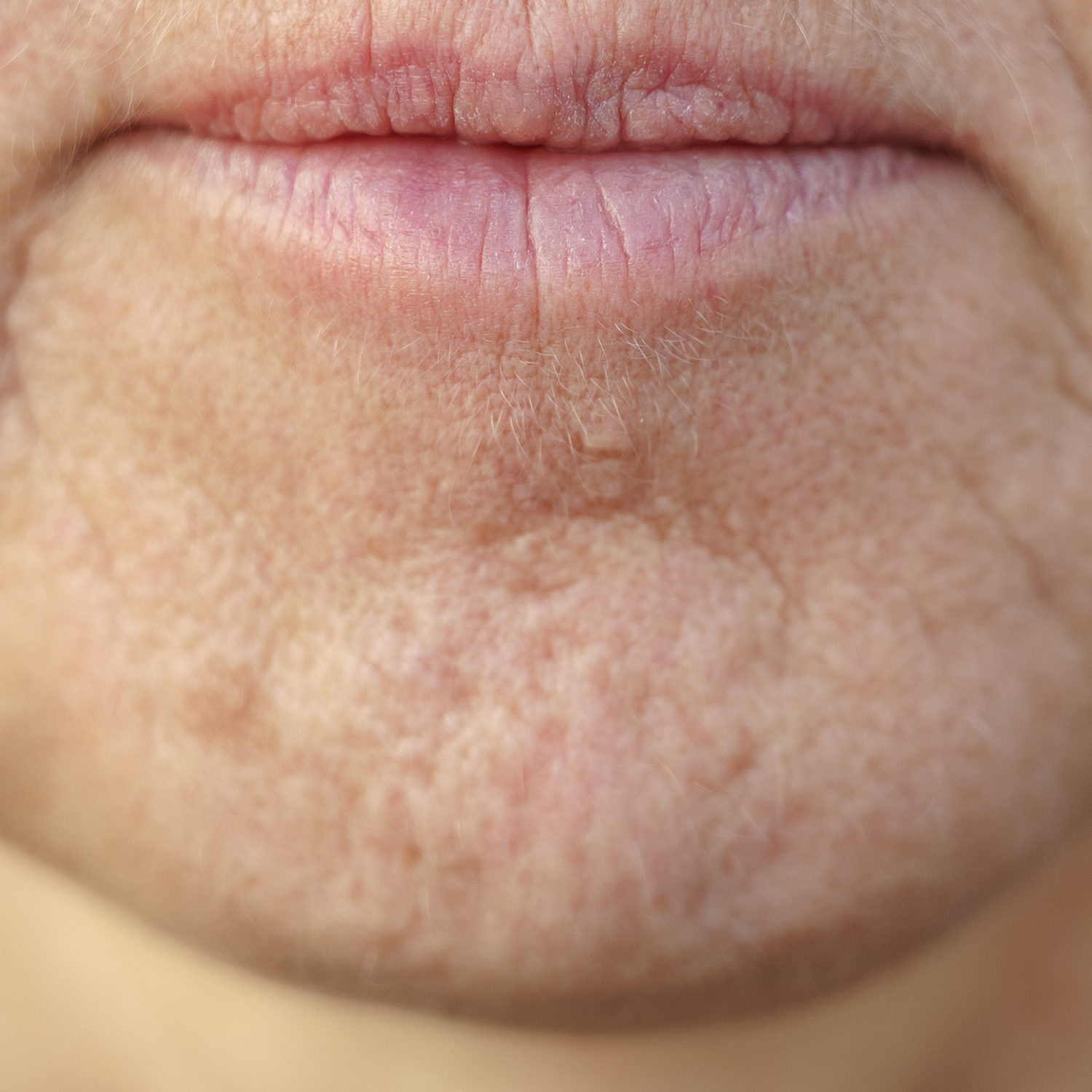 Chin Dimpling - NUIQ Wellness Lounge & Med Spa