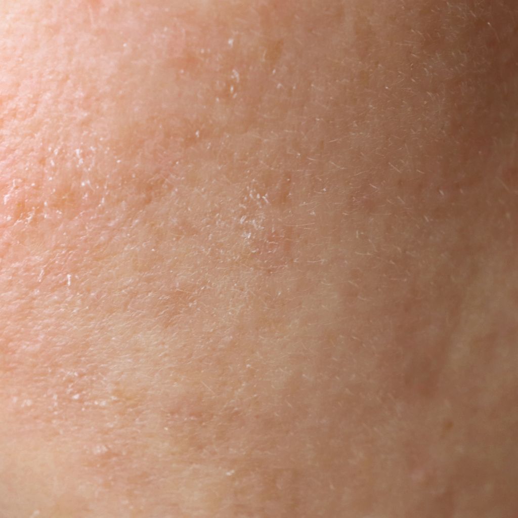 Dry Skin - NUIQ Wellness Lounge & Med Spa