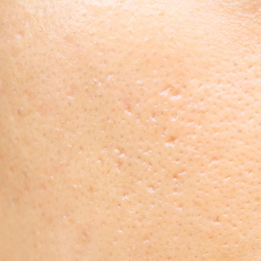 Poor Tone and Texture - NUIQ Wellness Lounge & Med Spa