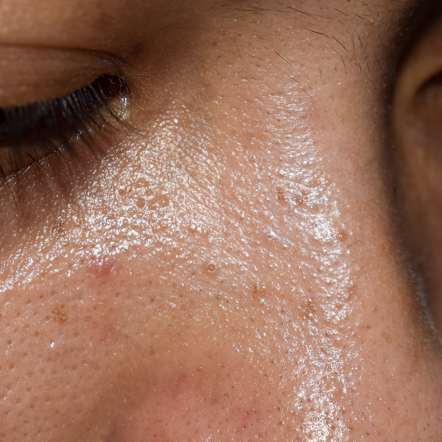 Oily Skin NUIQ Wellness Lounge Med Spa